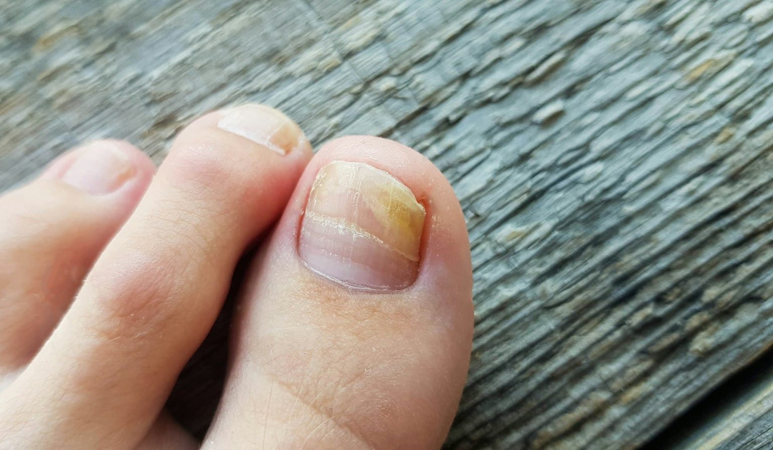 Neglesopp – symptomer og årsaker - Headless velbehagklinikk